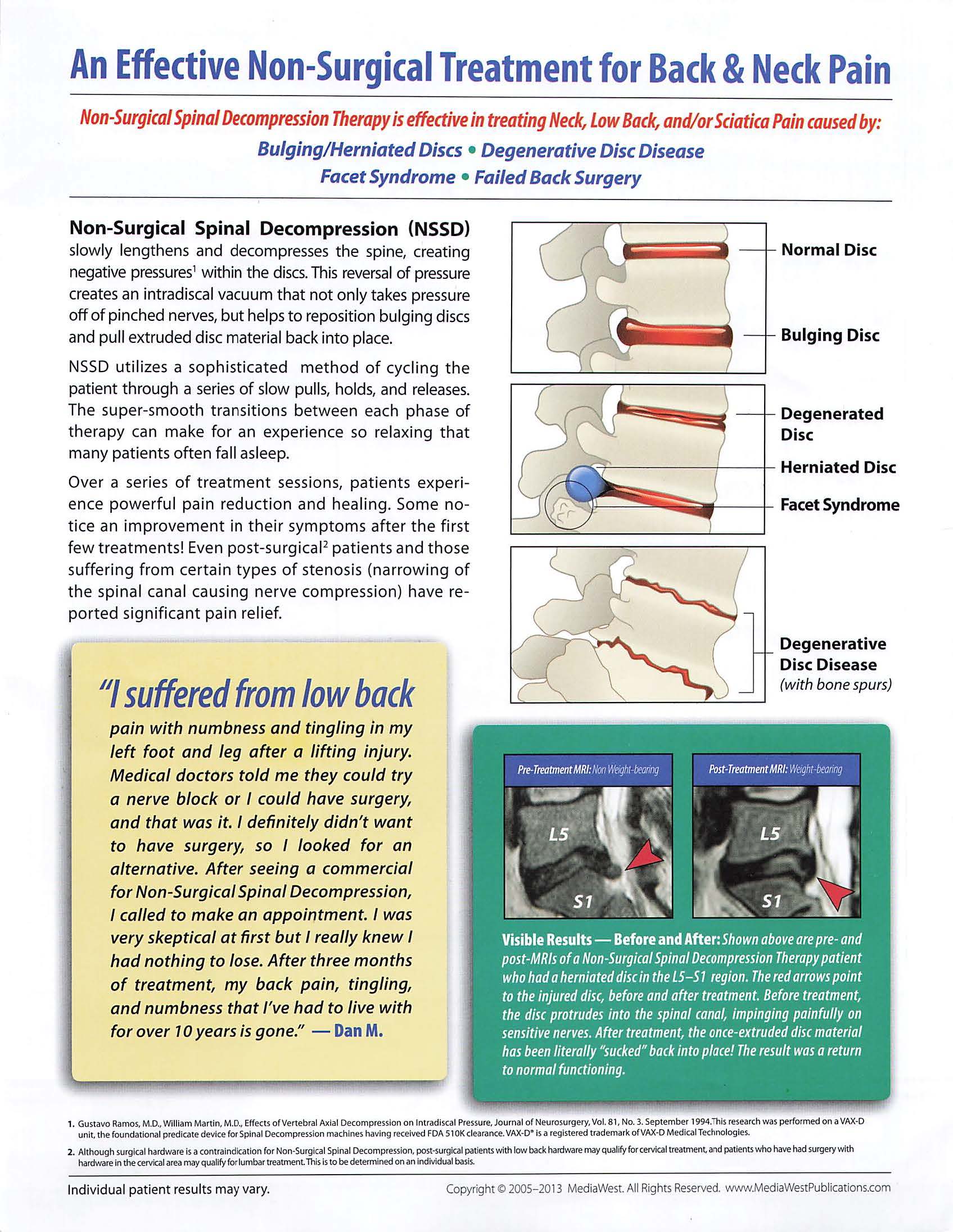 Non-Surgical Spinal Decompression Treatment